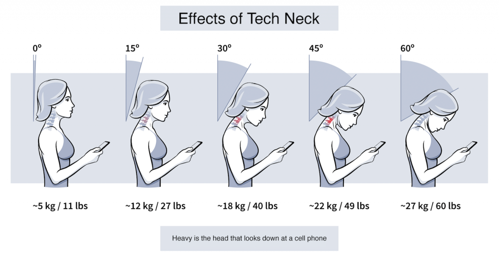 What is Tech Neck? Causes, Symptoms and Diagnosis