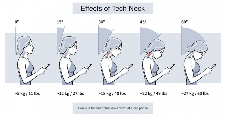 What is Tech Neck? Causes, Symptoms and Diagnosis